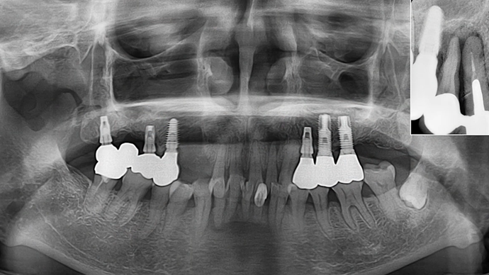 Digital Guided Surgery - MegaGen Oceania