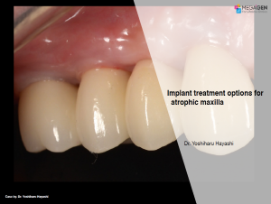Implant treatment options for atrophic maxilla - hun