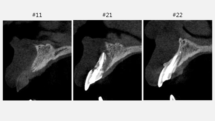 Aesthetic zone – MEGAGEN IMPLANT India