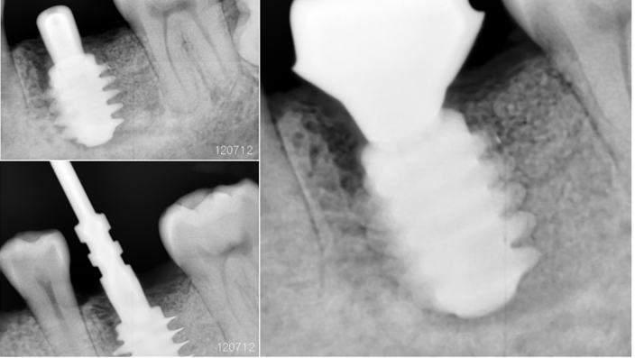 Single replacement - MEGAGEN IMPLANT India