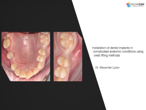 Installation of dental implants in complicated anatomic conditions ...