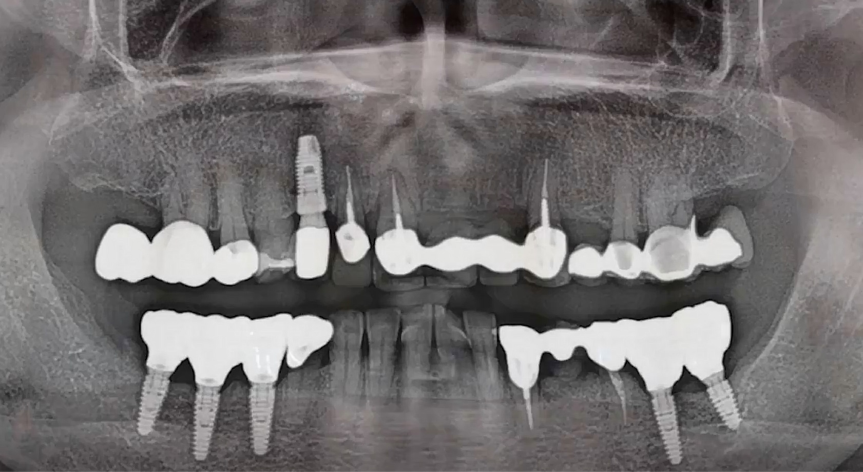 #11,12,23,24 Root Membrane Technique with Digital R2GATE Gate Surgery ...