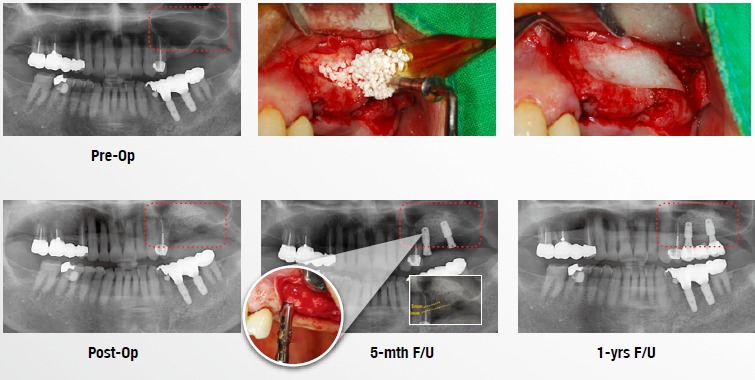 Synthetic bone graft: Bone Matrix I - MEGAGEN IMPLANT India