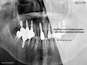 AnyRidge OctaOne Implant system with Root membrane technique - MEGAGEN ...