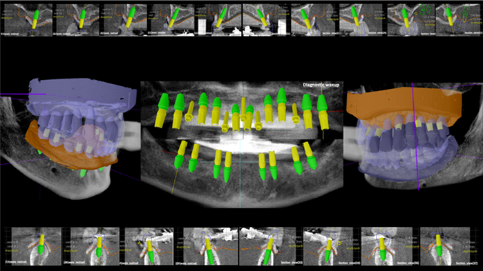 Digital Guided Surgery - MegaGen Malaysia