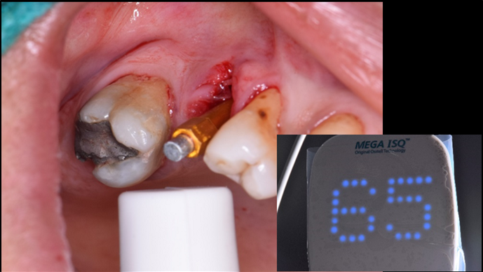 Digital Guided Surgery - MEGAGEN IMPLANT - Mexico