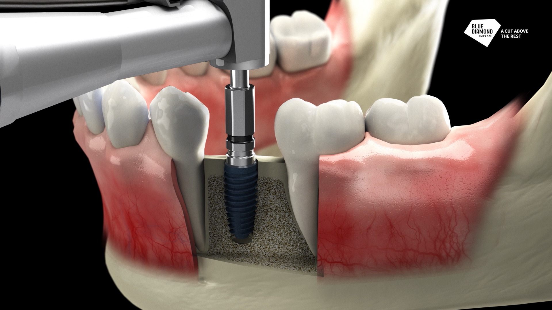 BLUEDIAMOND IMPLANT® - Thailand