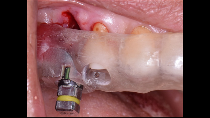Digital Guided Surgery - MEGAGEN IMPLANT