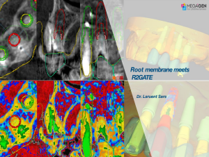 Root membrane meets R2GATE - MEGAGEN IMPLANT