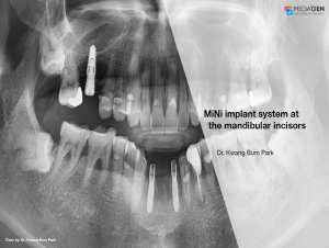 MiNi implant system at the mandibular incisors - MEGAGEN IMPLANT