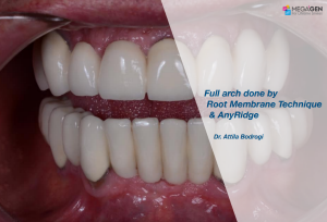 Full arch done by Root Membrane Technique & AnyRidge - MEGAGEN IMPLANT