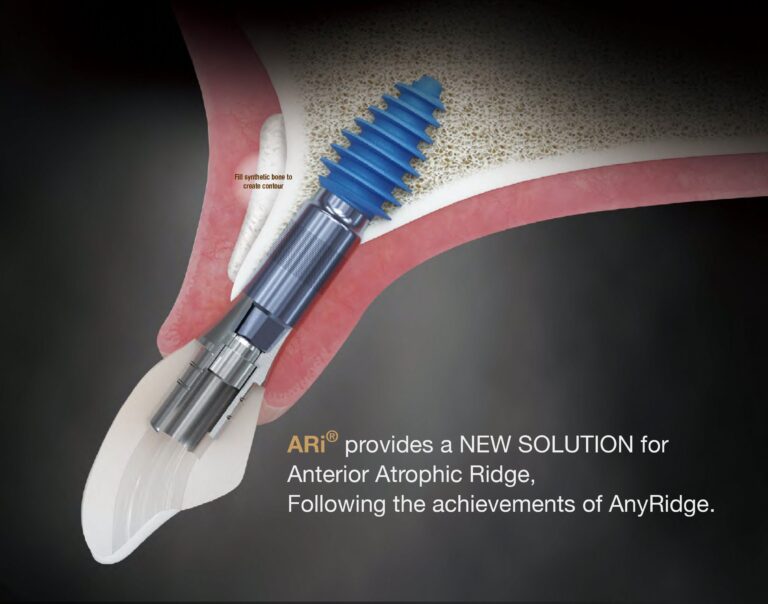 ARi® - MEGAGEN IMPLANT