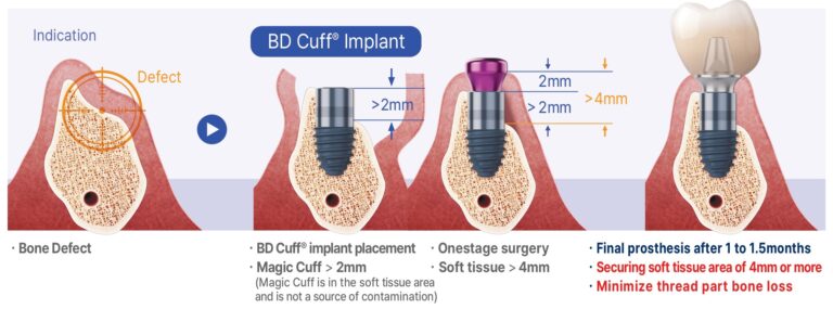 BD Cuff ® - MEGAGEN IMPLANT